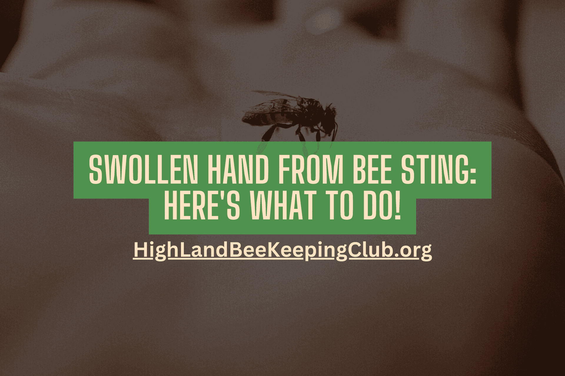 How To Treat Swollen Hand From Bee Sting: Here's What To Do!